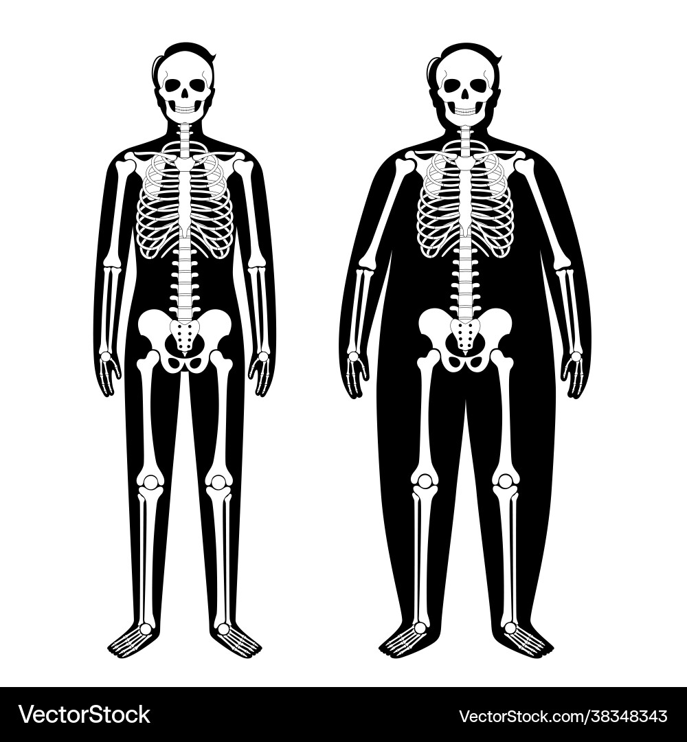 Obese Skeleton Anatomie - menschliche Knochen Vektorbild