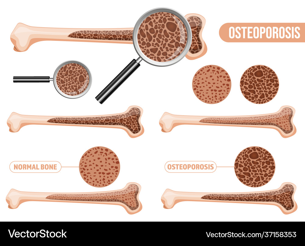 Osteoporosis: Brittle Bone Disease Royalty Free Vector Image