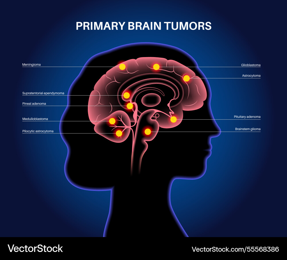 Primary brain tumors Royalty Free Vector Image