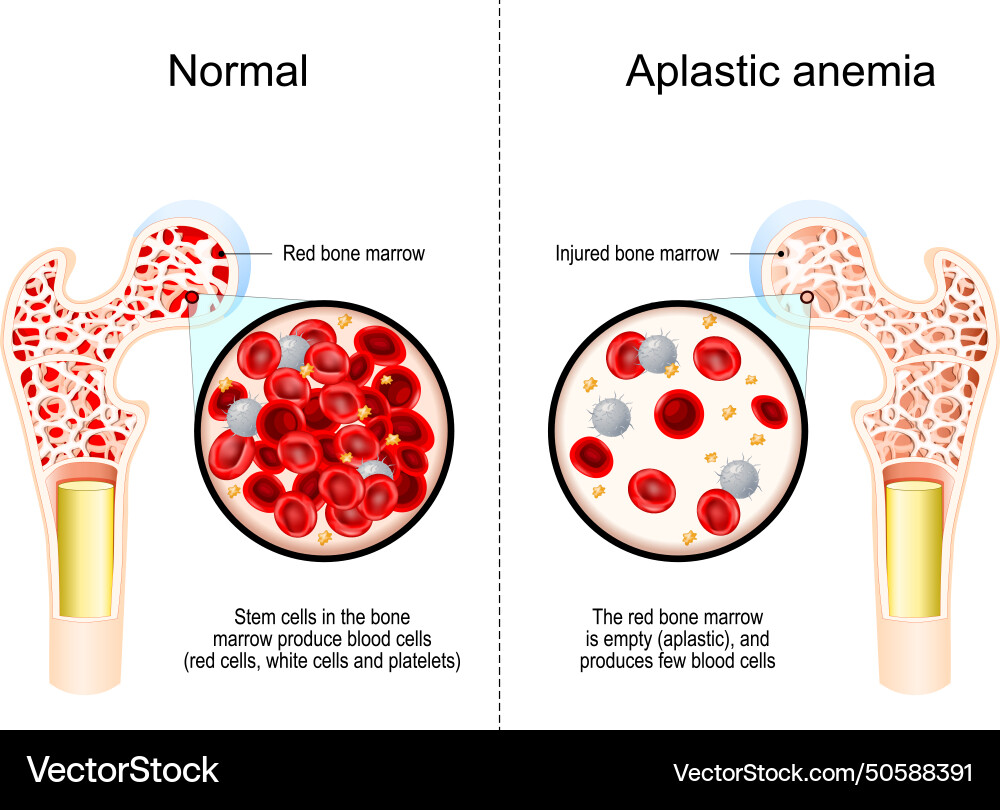 Bone Marrow Failure - Aplastic Anemia Royalty Free Vector