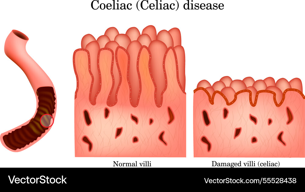 Coeliac disease intestinal damage Royalty Free Vector Image