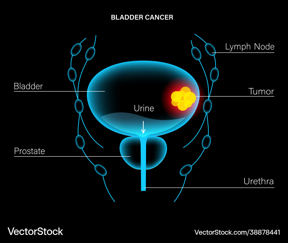 Bladder Cancer Anatomy & Stages Royalty Free Vector