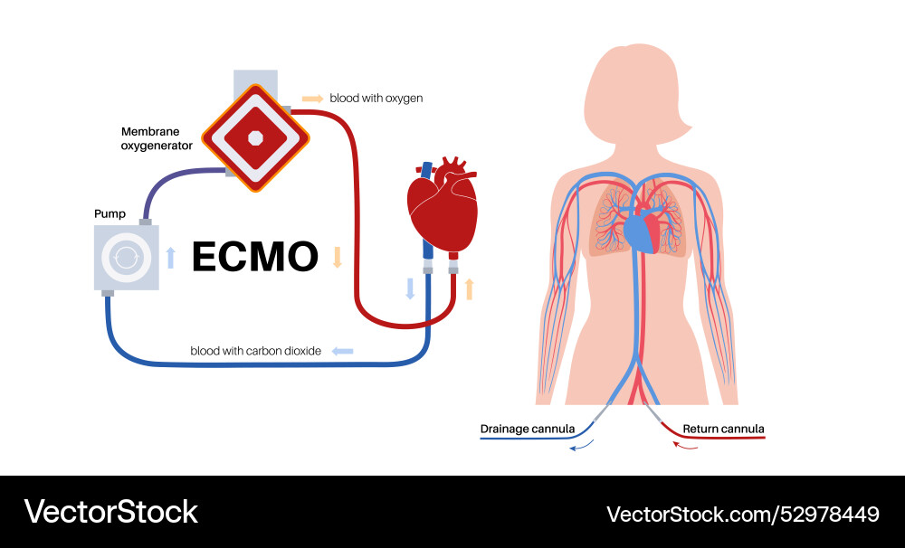 Extracorporeal membrane oxygenation Royalty Free Vector