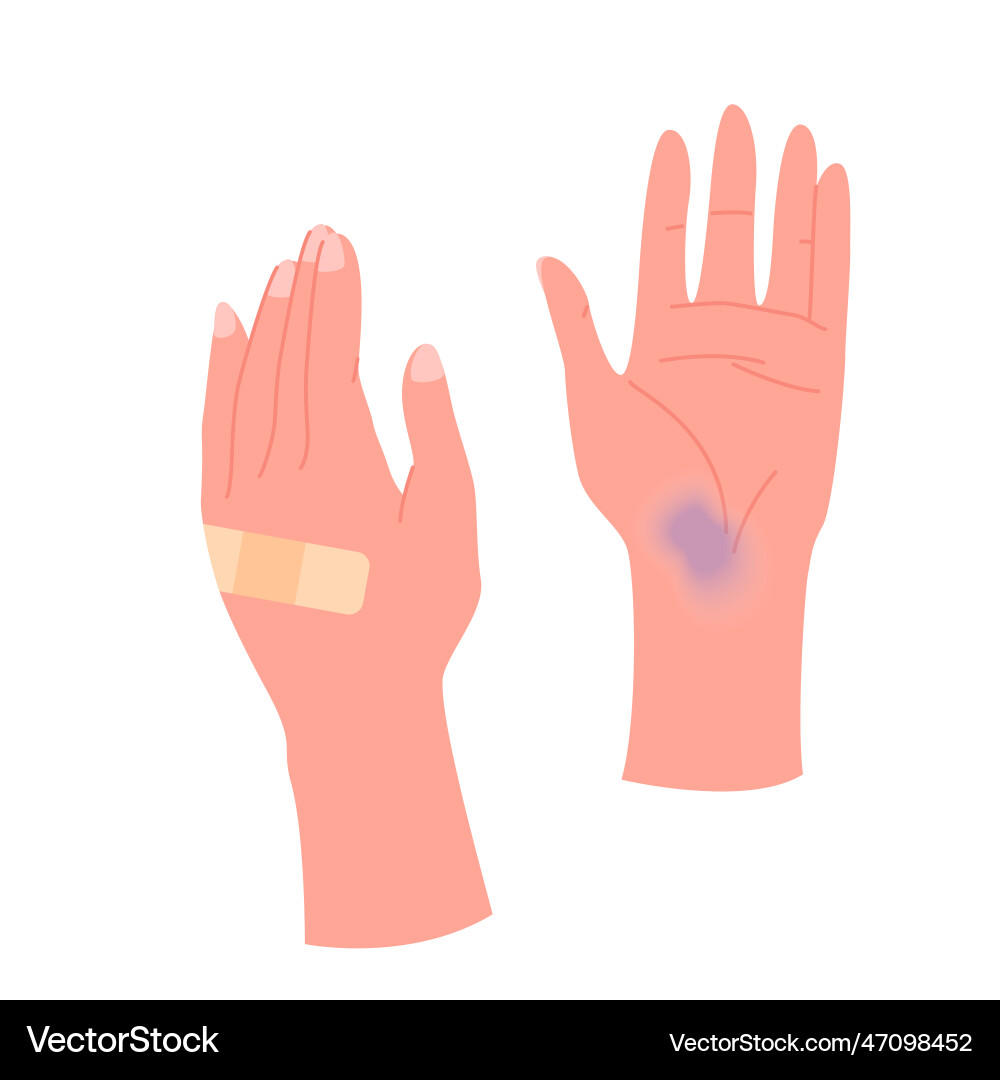 Human hands with band aid bruise on palm two Vector Image