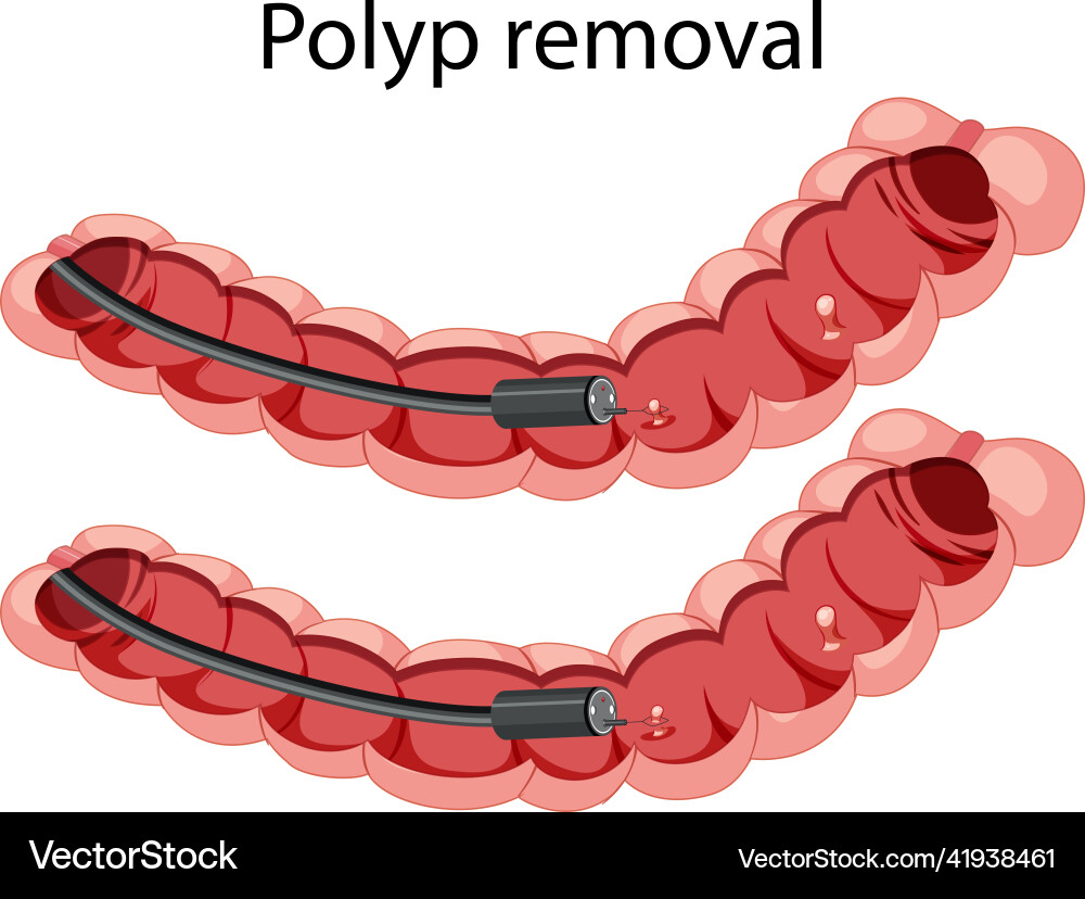 Diagram showing polyp removal Royalty Free Vector Image