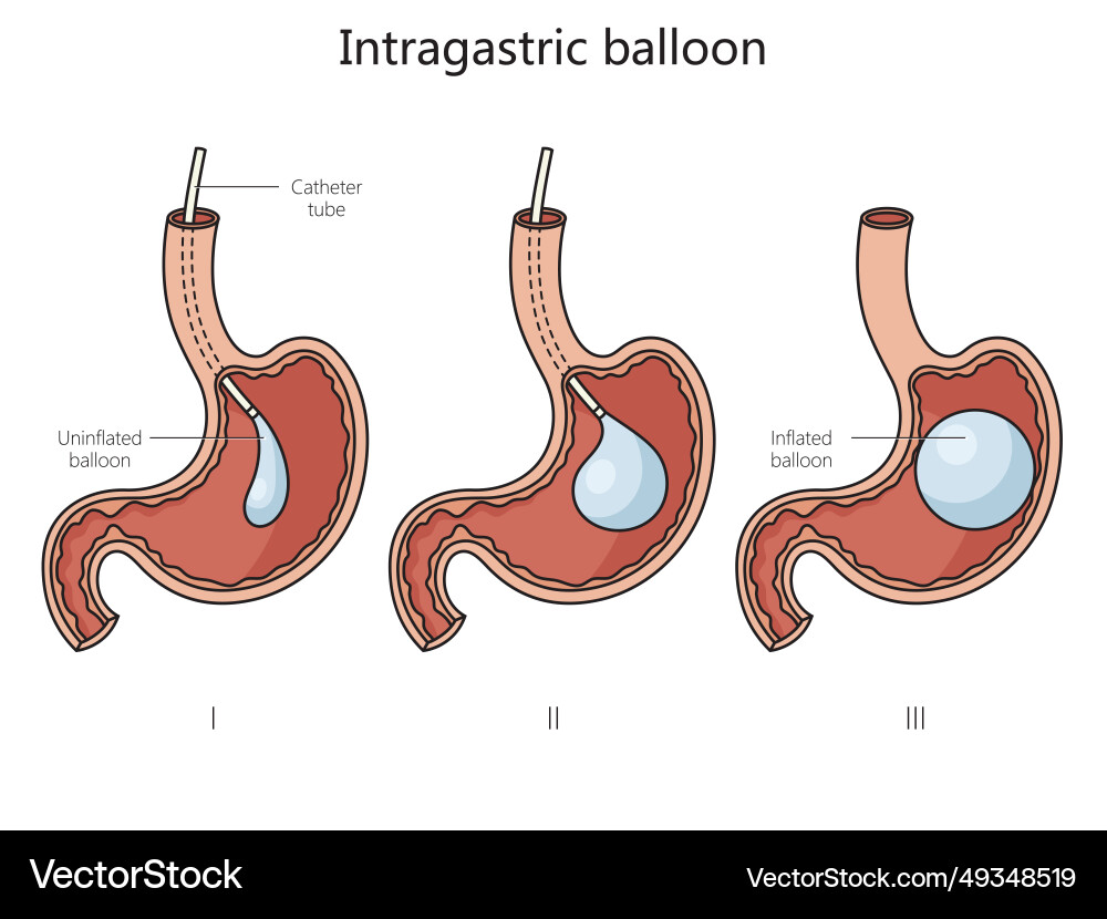 Intragastric stomach balloon structure medical Vector Image