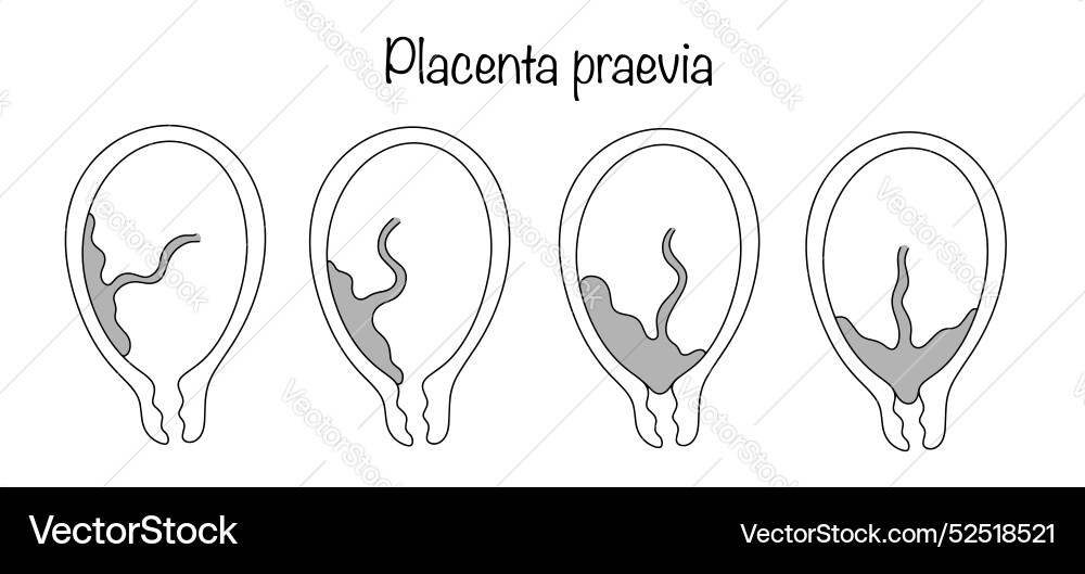 Placenta praevia Royalty Free Vector Image - VectorStock