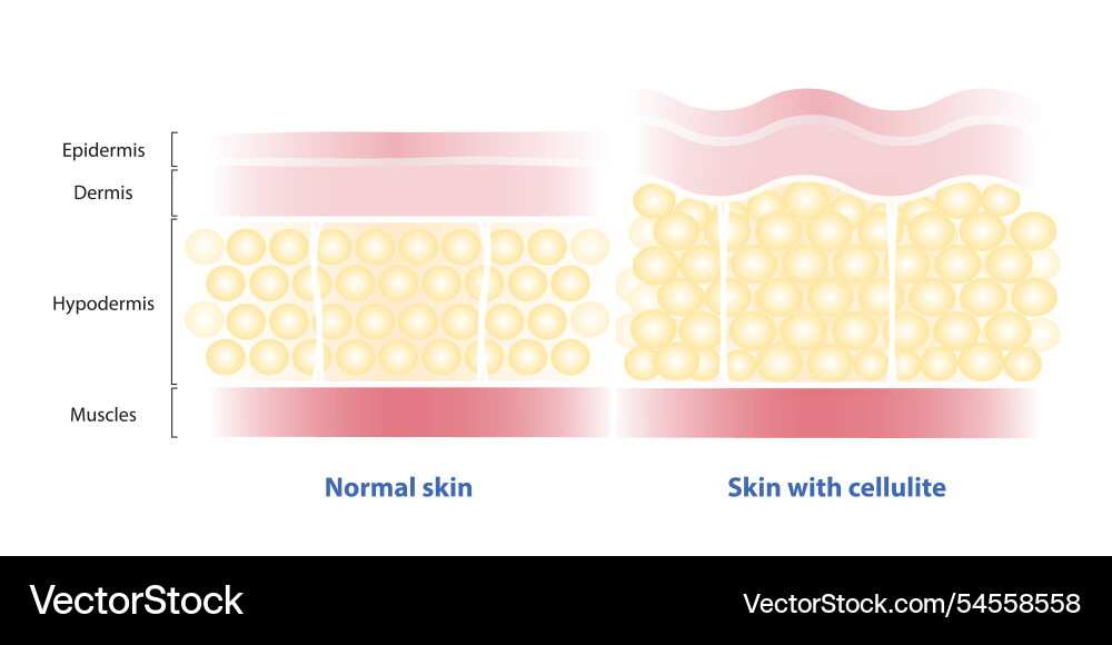 Comparison of normal skin and with cellulite Vector Image