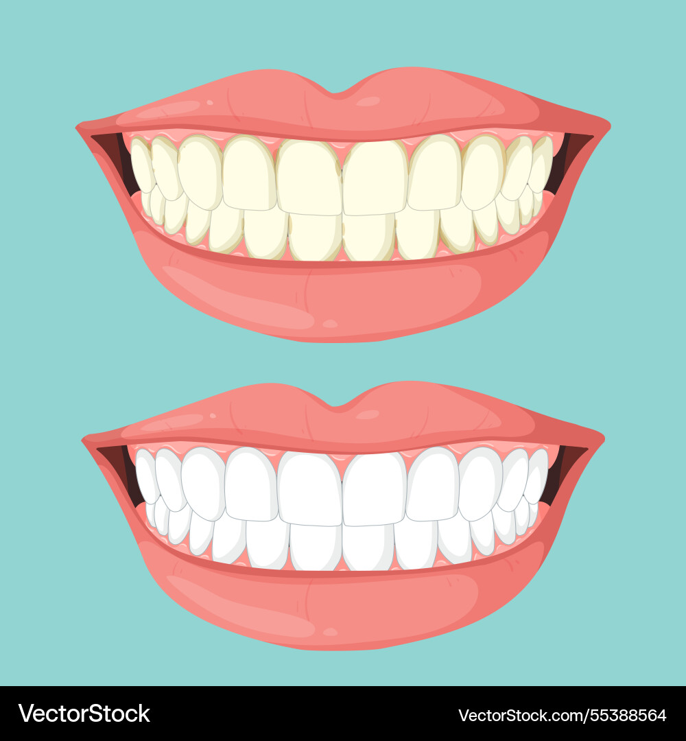 Showing teeth whitening transformation Royalty Free Vector