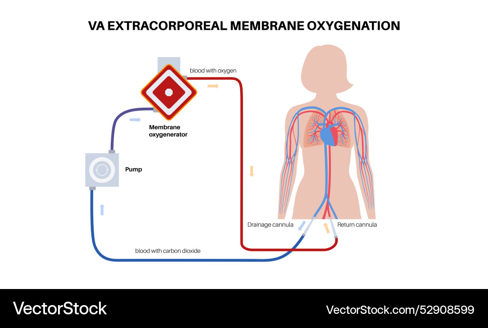 Extracorporeal membrane oxygenation Royalty Free Vector