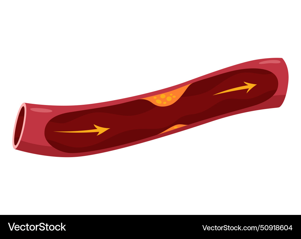 Atherosclerosis Plaque Anatomy Royalty Free Vector Image