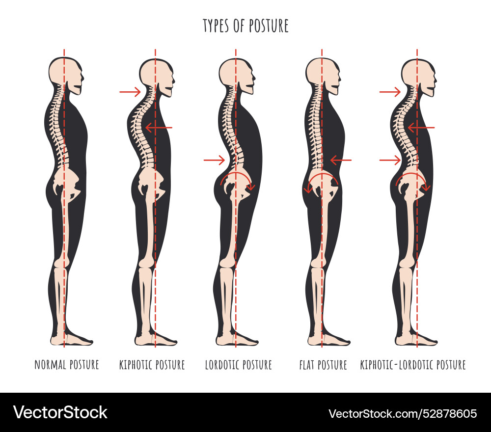 Type of posture postural syndromes infographic Vector Image