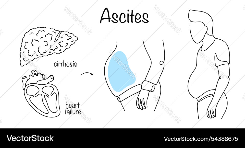Ascites Royalty Free Vector Image - VectorStock