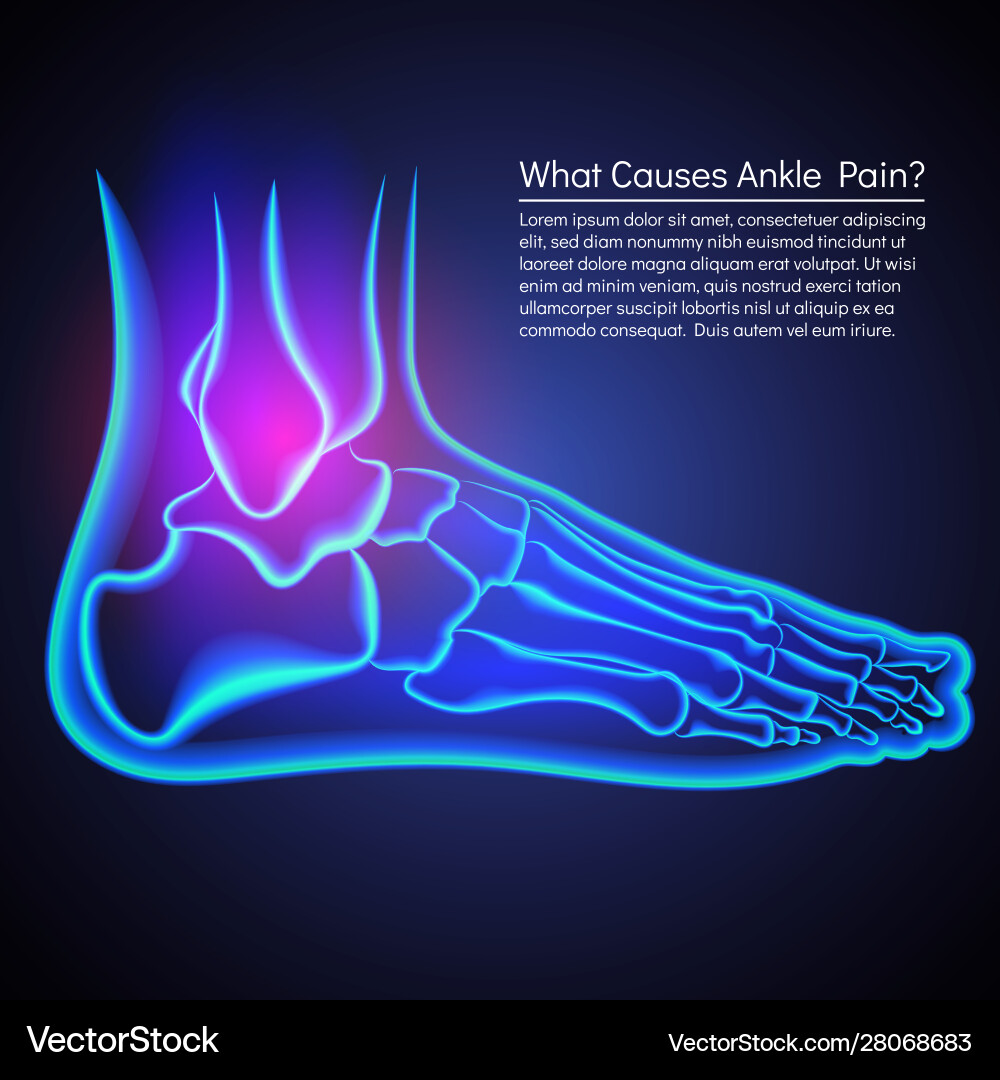 A broken ankle x-ray anatomy pain Royalty Free Vector Image