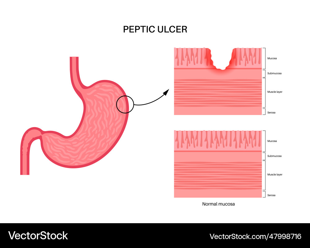 Peptic Ulcer Disease Anatomy Royalty Free Vector Image