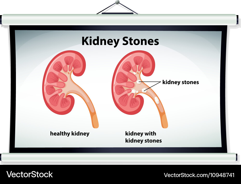 Diagram showing kidney stones Royalty Free Vector Image