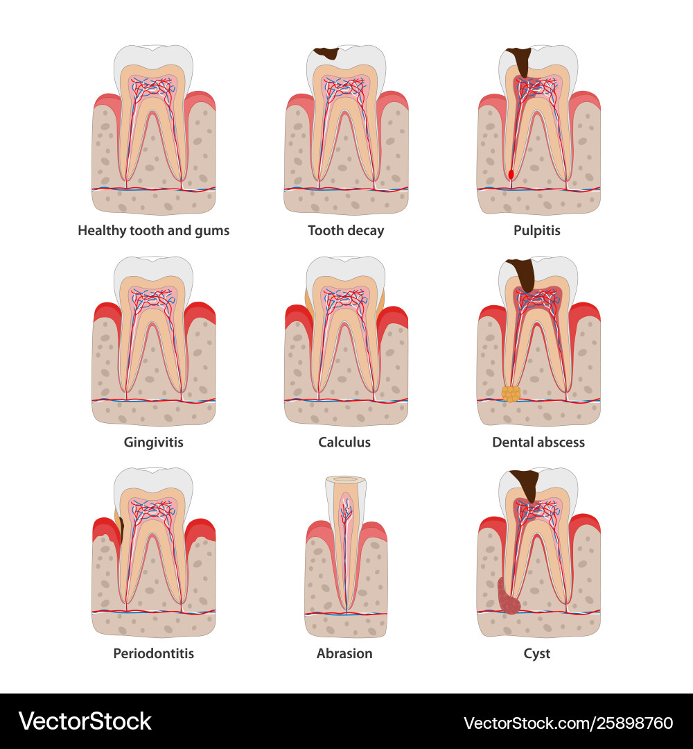 Popular teeth diseases icons in flat design Vector Image