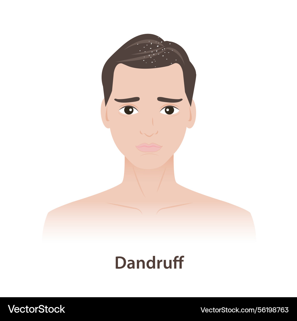 Man with dandruff in hair Royalty Free Vector Image