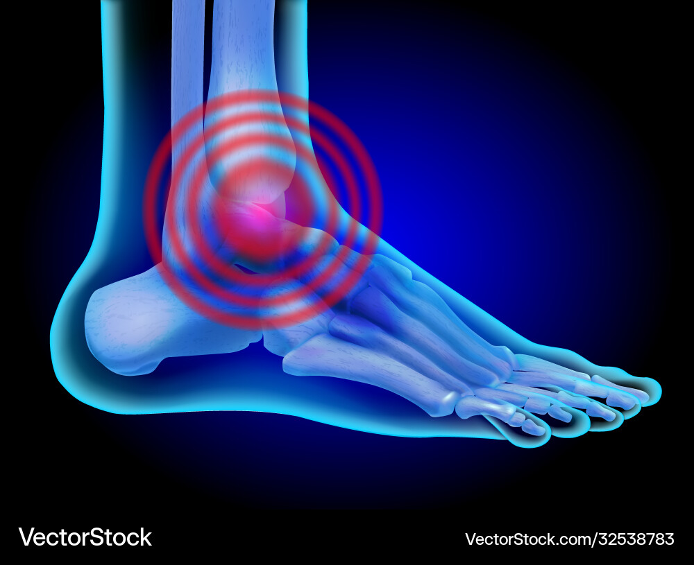 Human foot leg skeleton joint inflammation Vector Image