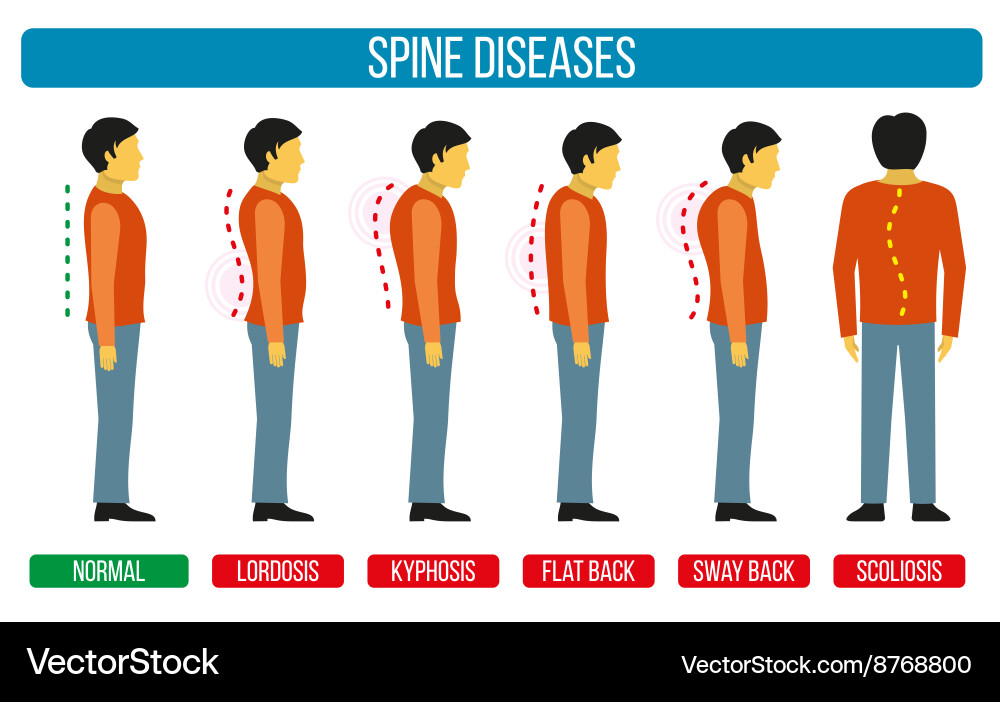 Body posture defect infographics of spine Vector Image