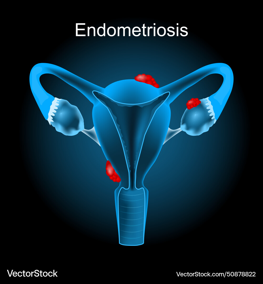 Endometriosis cross section of a human uterus Vector Image