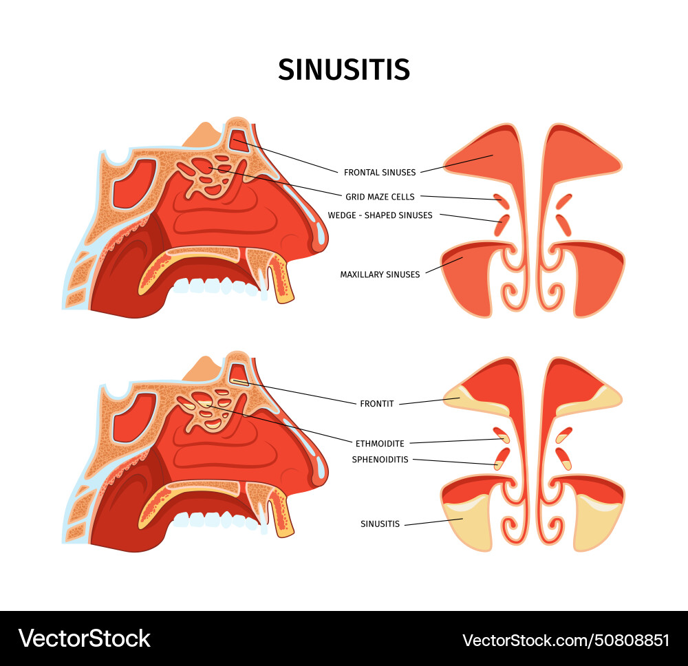 Sinusitis infographics Royalty Free Vector Image