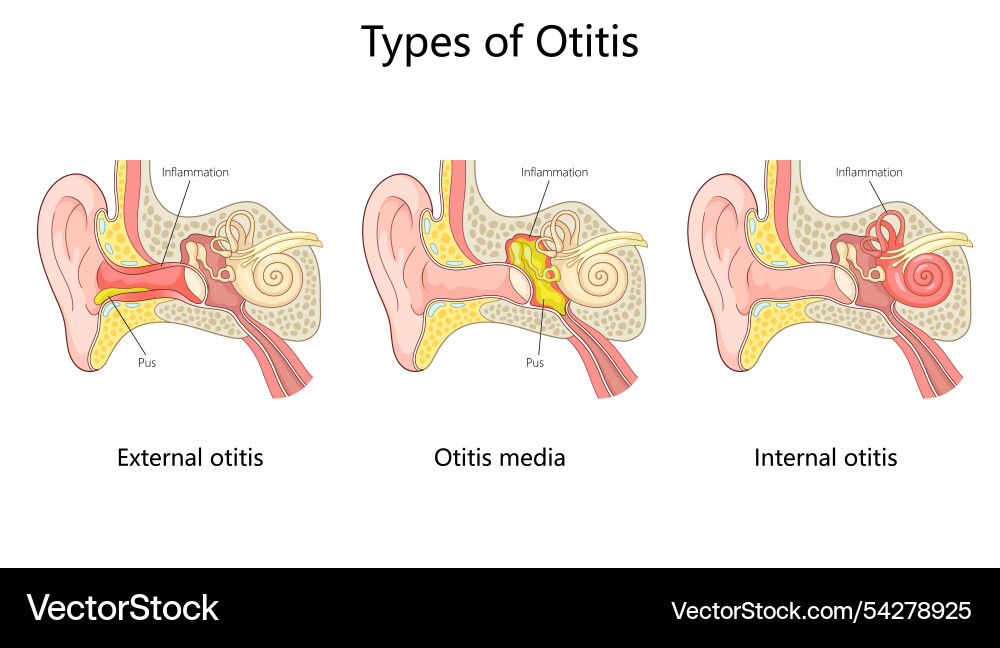 Types of otitis external media internal infections