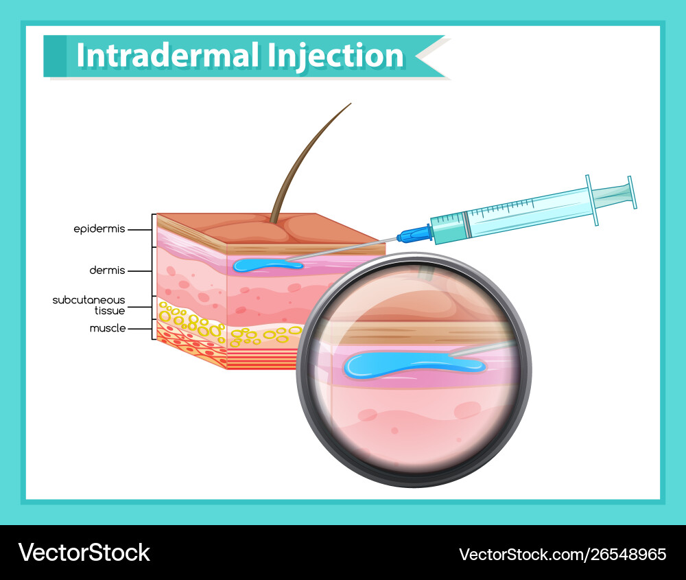 Intradermal Route
