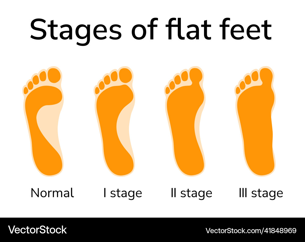 Stages of flat feet Royalty Free Vector Image - VectorStock