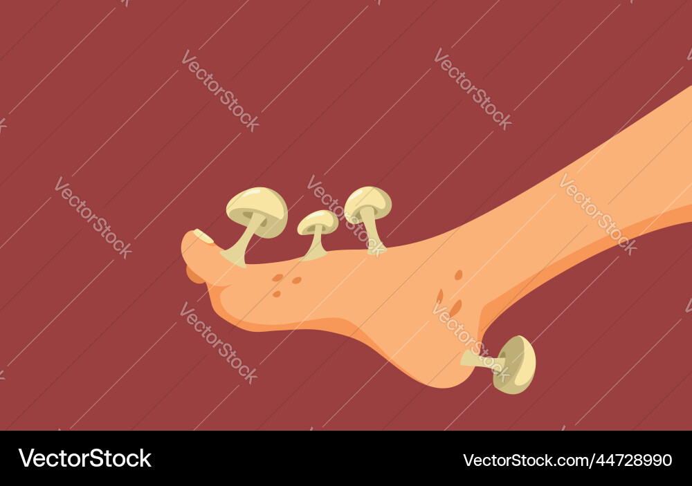 Foot with fungus problem concept cartoon Vector Image