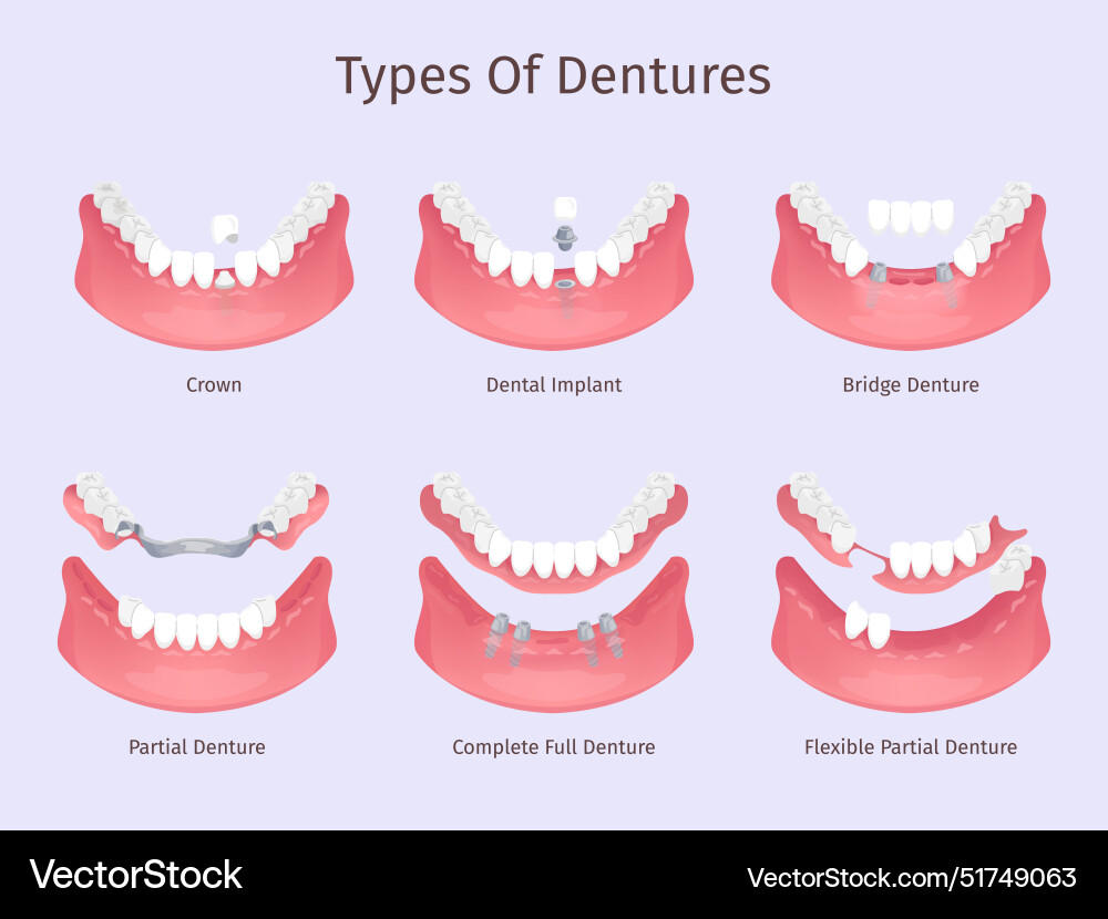Dentures types tooth biting restorations dental Vector Image