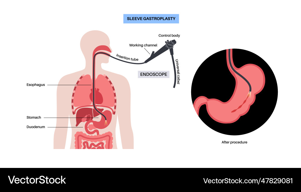 Endoscopic sleeve gastroplasty Royalty Free Vector Image