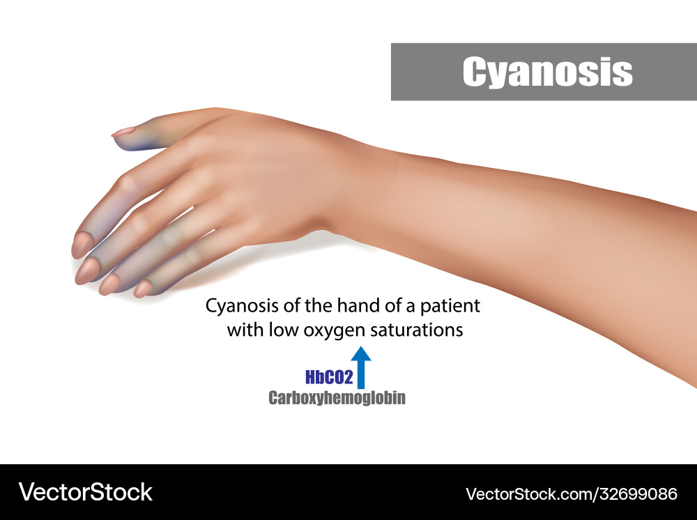 Cyanosis hand a patient with low oxygen Royalty Free Vector
