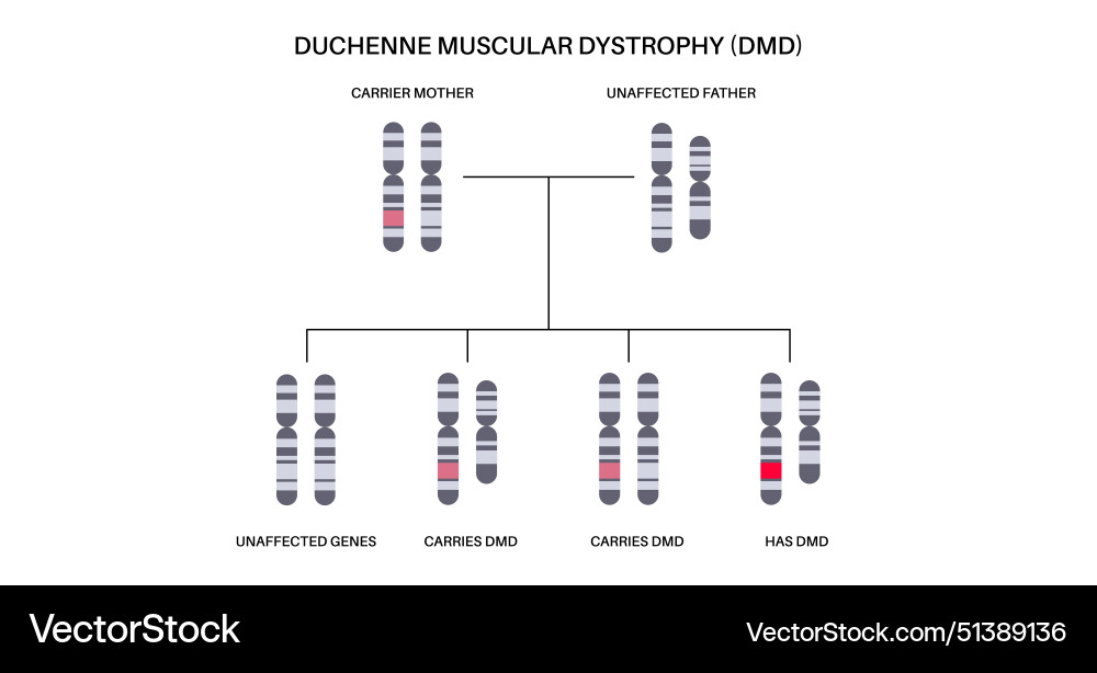 Duchenne muscular dystrophy Royalty Free Vector Image