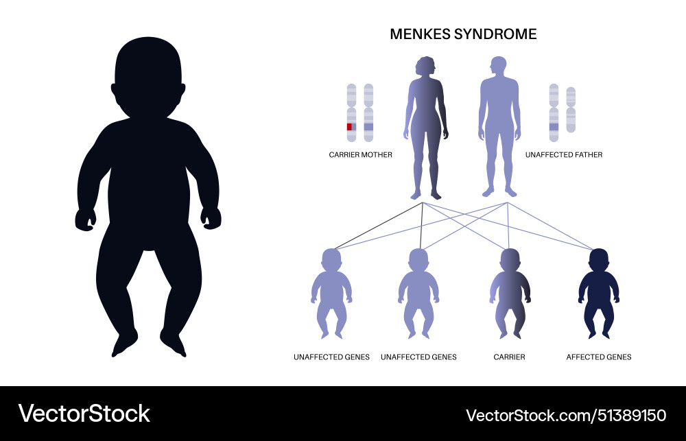 Menkes syndrome poster Royalty Free Vector Image