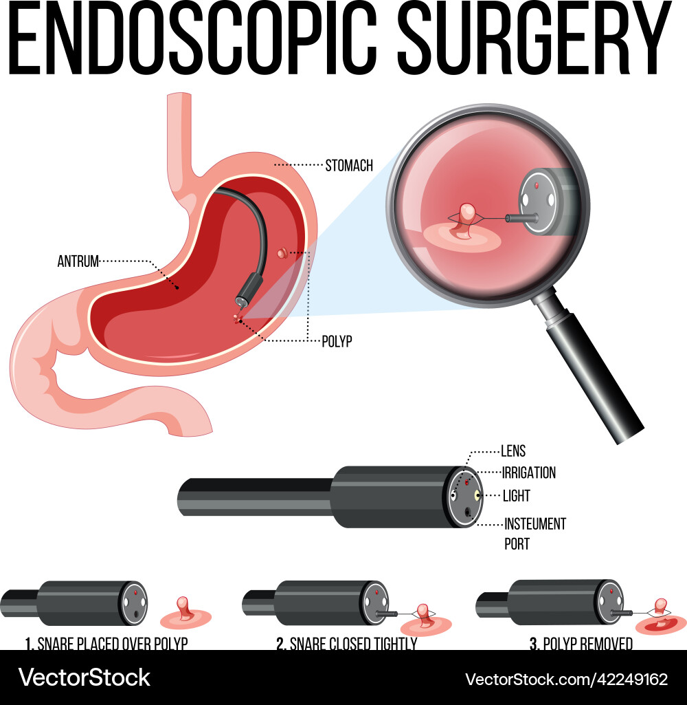 Diagram showing endoscopic surgery Royalty Free Vector Image