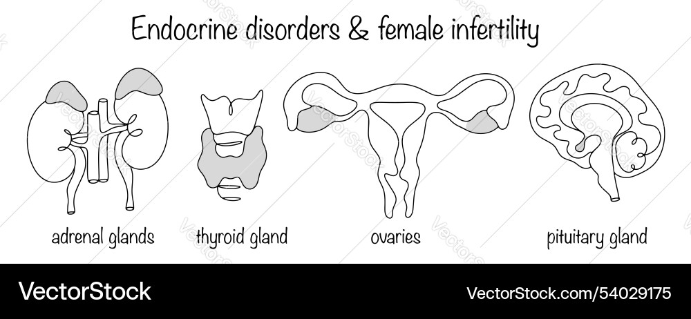 Endocrine glands female infertility Royalty Free Vector