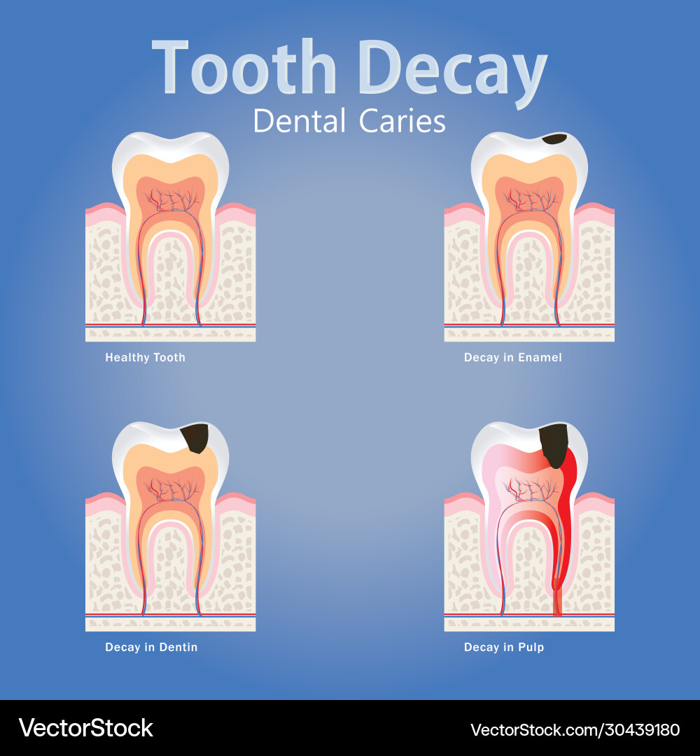 Stages tooth decay Royalty Free Vector Image - VectorStock