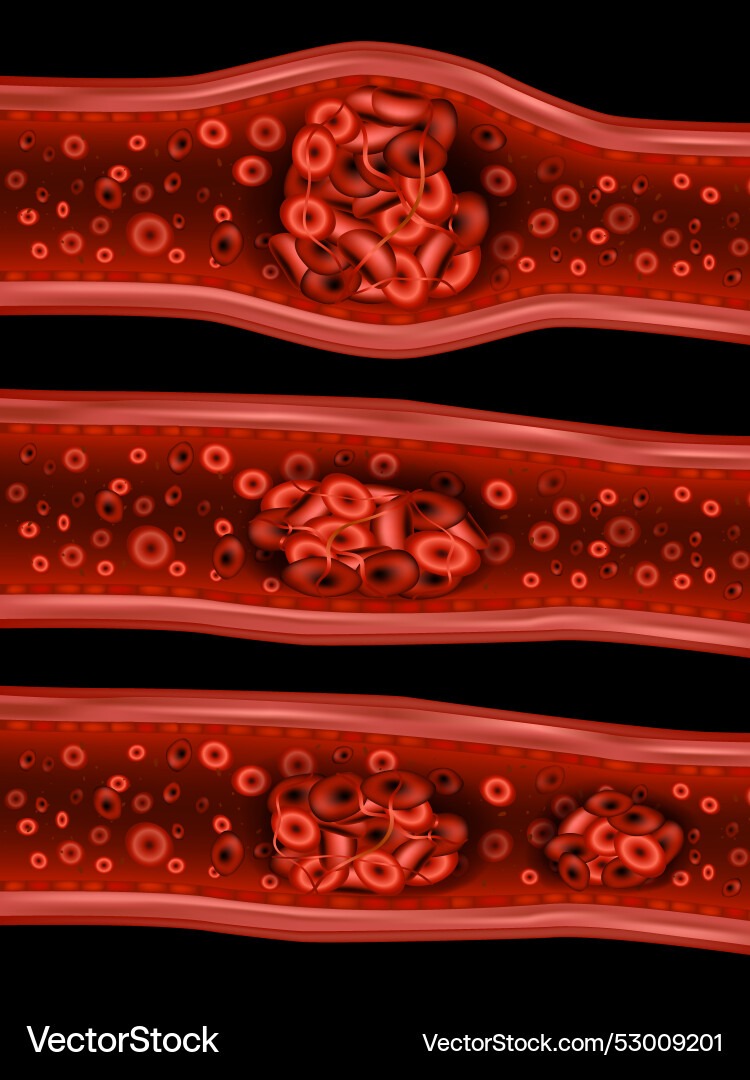 The thrombus types of blood Royalty Free Vector Image