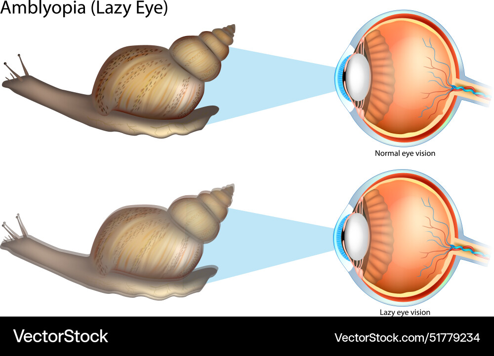 Amblyopia or lazy eye vision and normal Royalty Free Vector