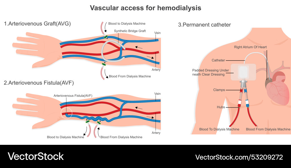 Vascular access for hemodialysis Royalty Free Vector Image
