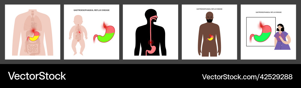 Gastroesophageal reflux disease Royalty Free Vector Image