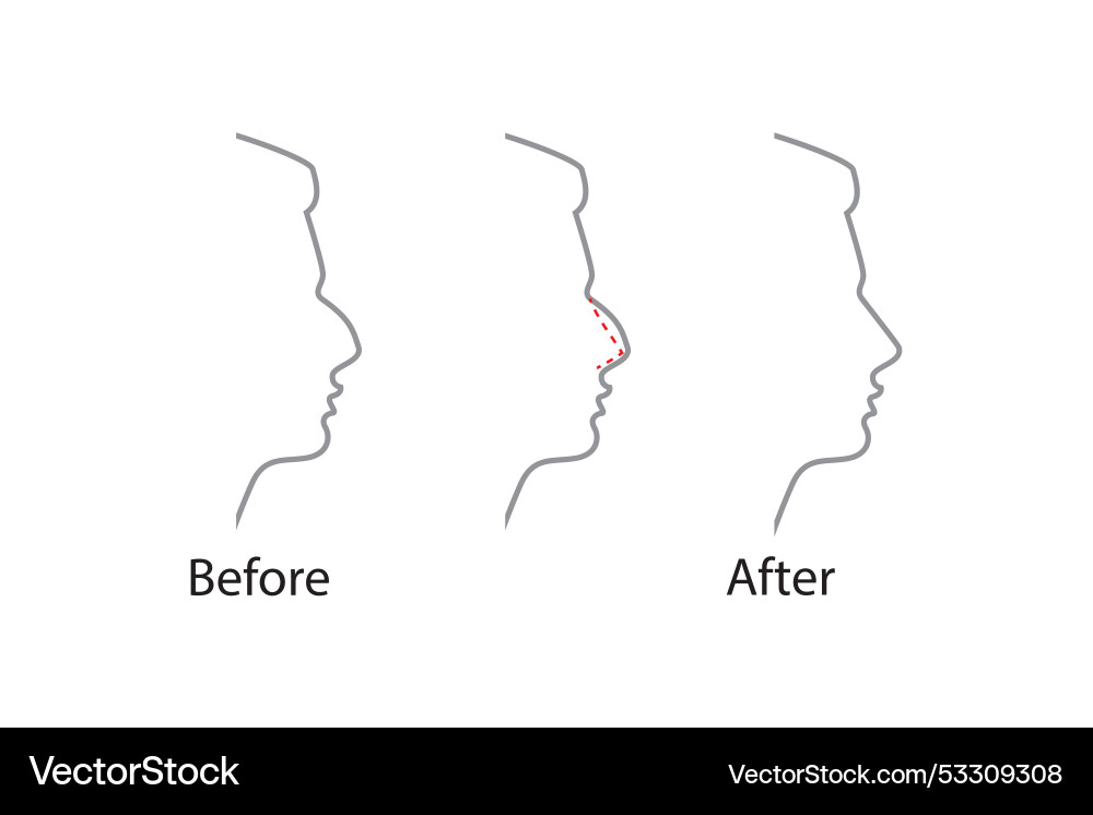 Rhinoplasty nose plastic surgey icon Royalty Free Vector