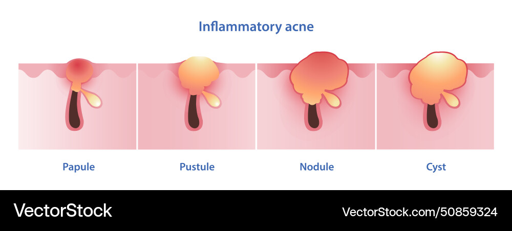 Diagram of inflammatory acne types Royalty Free Vector Image