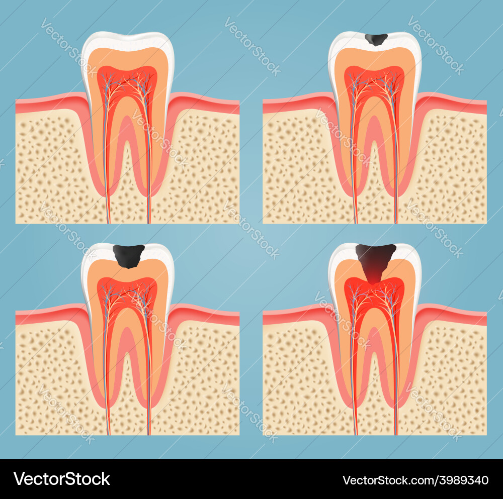 Stages of tooth decay Royalty Free Vector Image