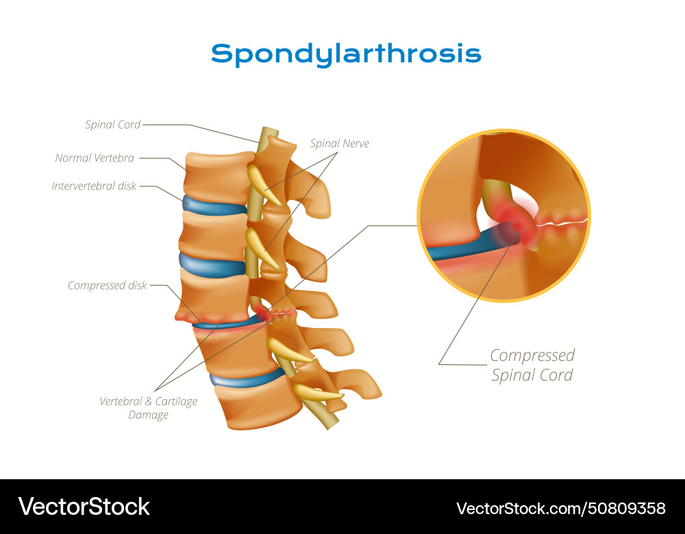 Spondylarthrosis spinal cord infographics Vector Image