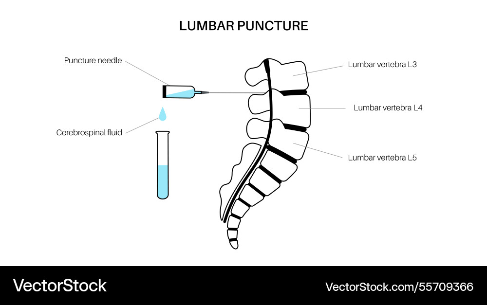 Lumbar puncture spinal tap Royalty Free Vector Image