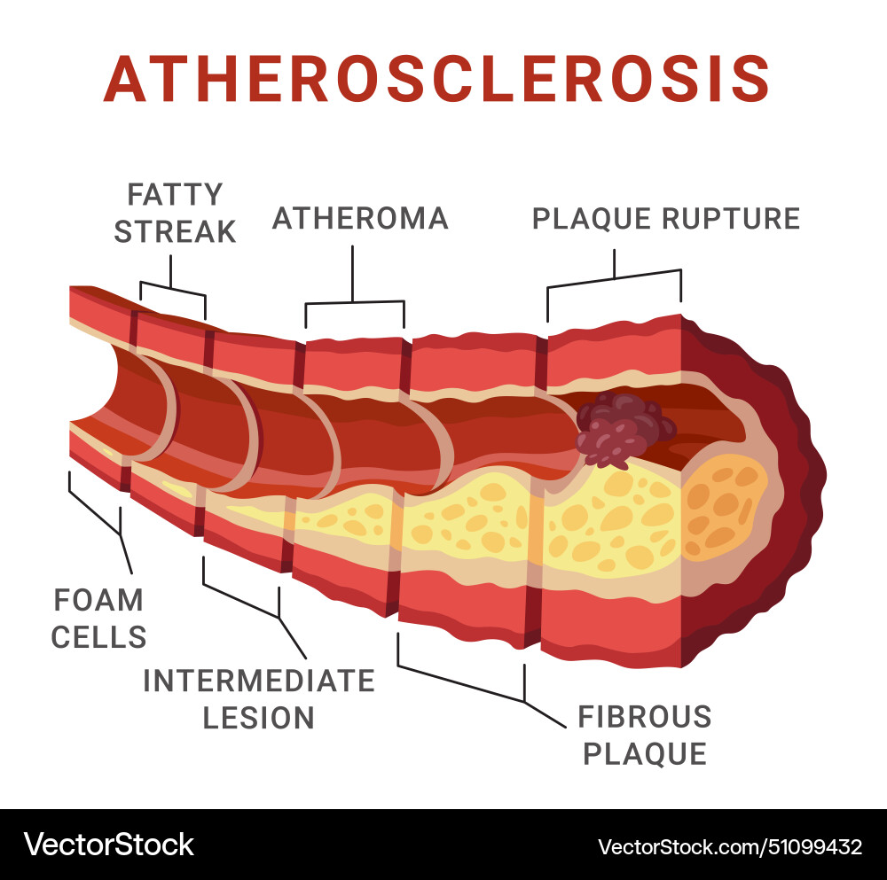 Atherosclerosis formation artery cross section Vector Image