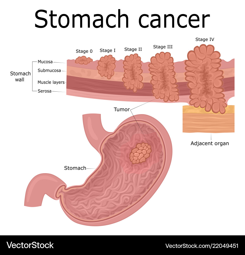 Stomach cancer Royalty Free Vector Image - VectorStock