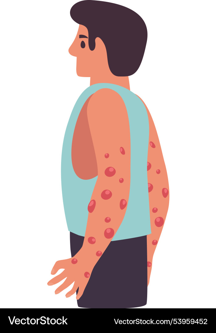 Patient with monkey pox disease Royalty Free Vector Image